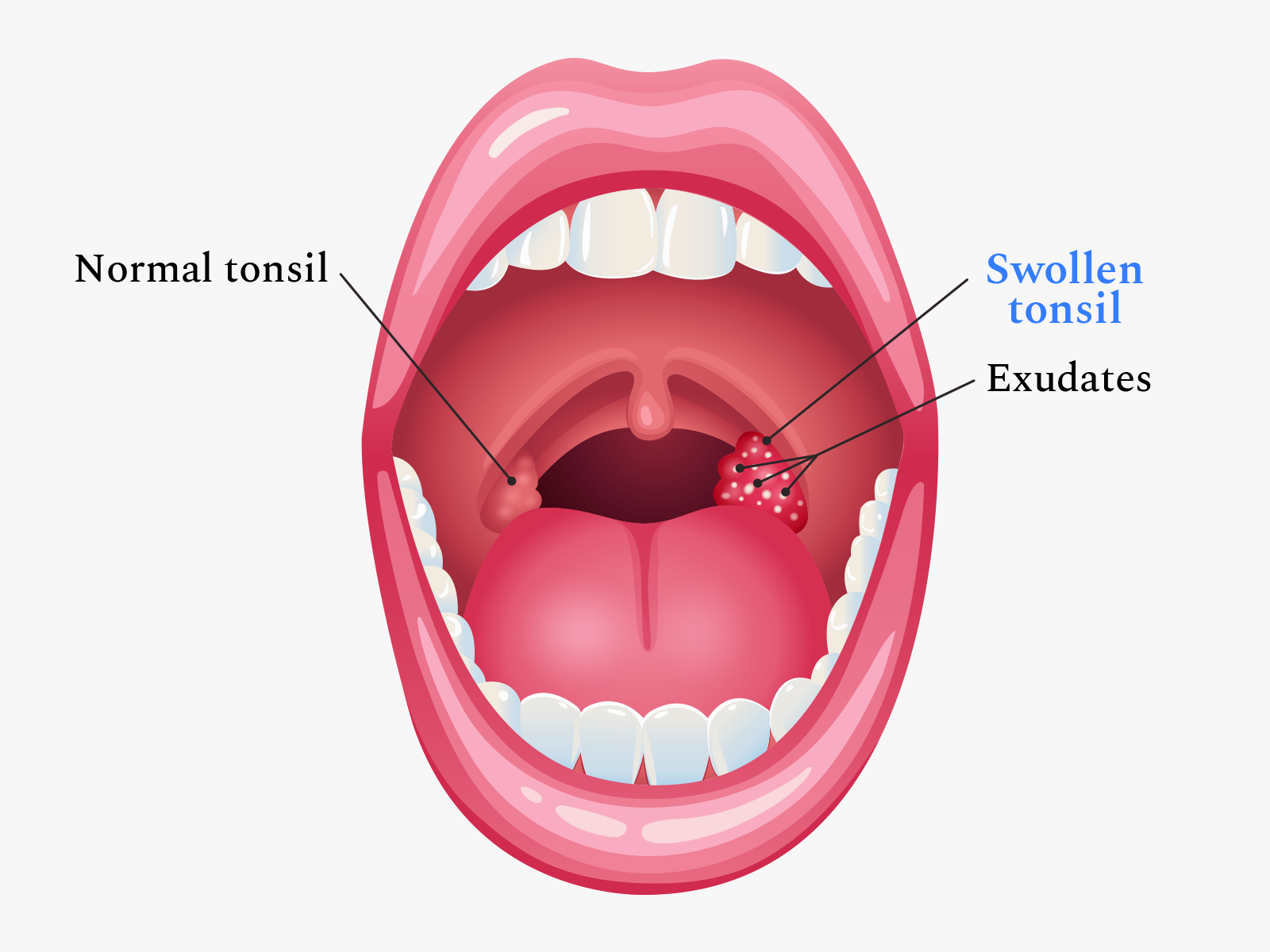 Swollen Tonsils Strep Throat