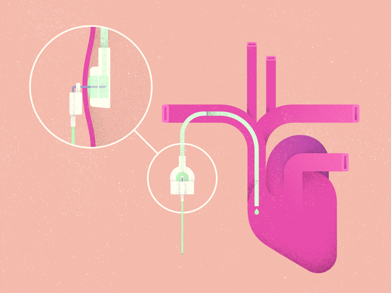 Chemo port by Patrick Mahoney on Dribbble
