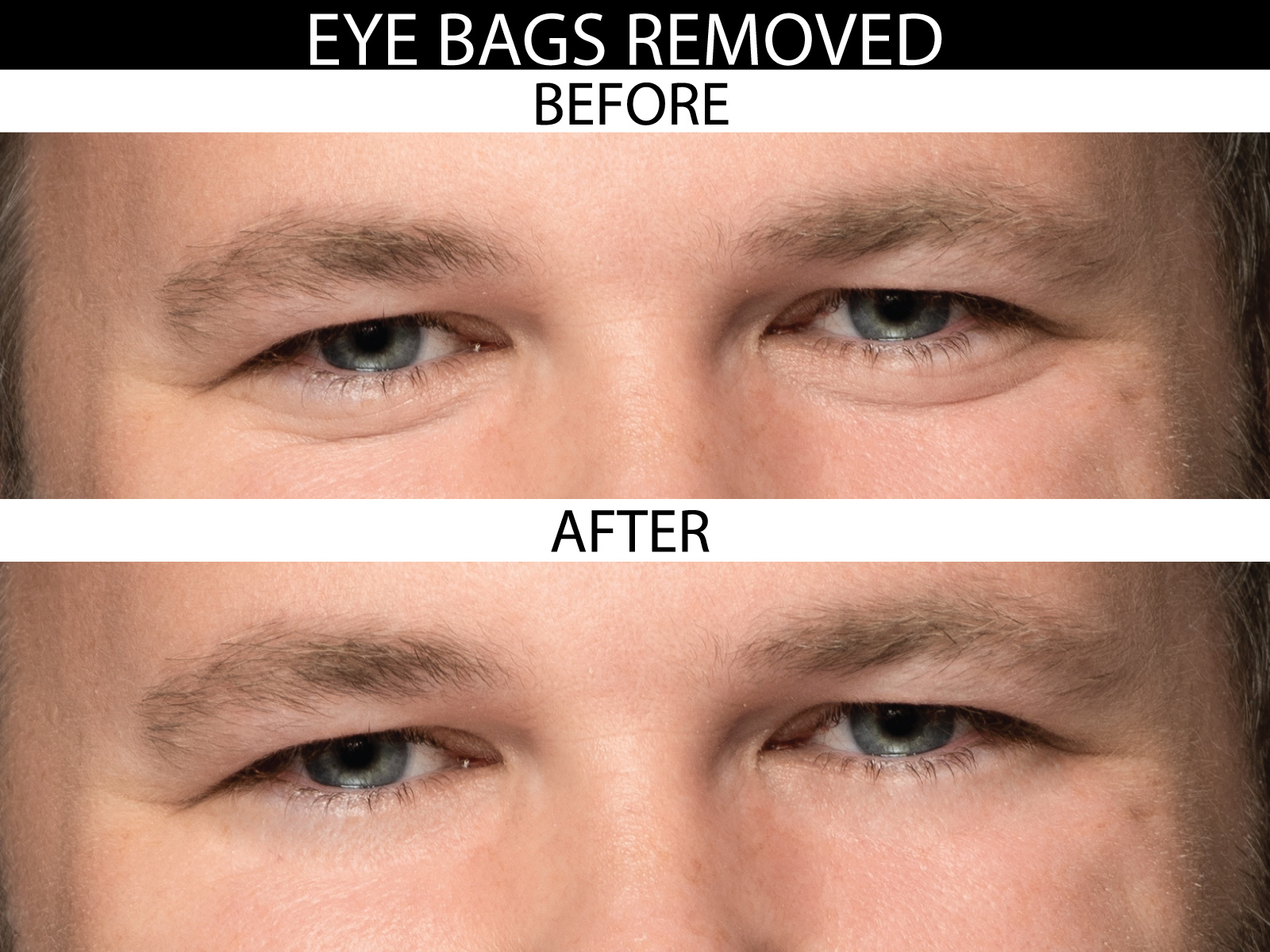 Eye Bags Removal by Omer Ameer on Dribbble
