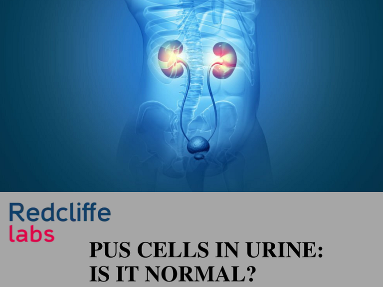Pus Cells In Urine Is It Normal What Is The Normal Range By Daniel pus-cells-in-urine-is-it-normal-what-is-the-normal-range-by-daniel