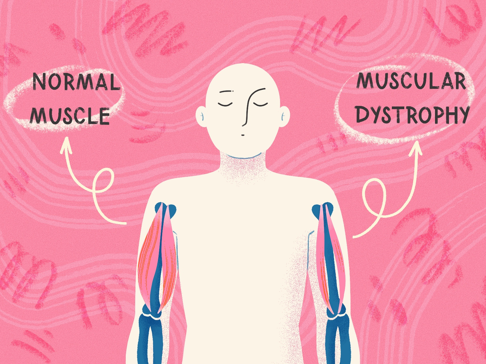 Muscular Dystrophy by Julie Mash on Dribbble