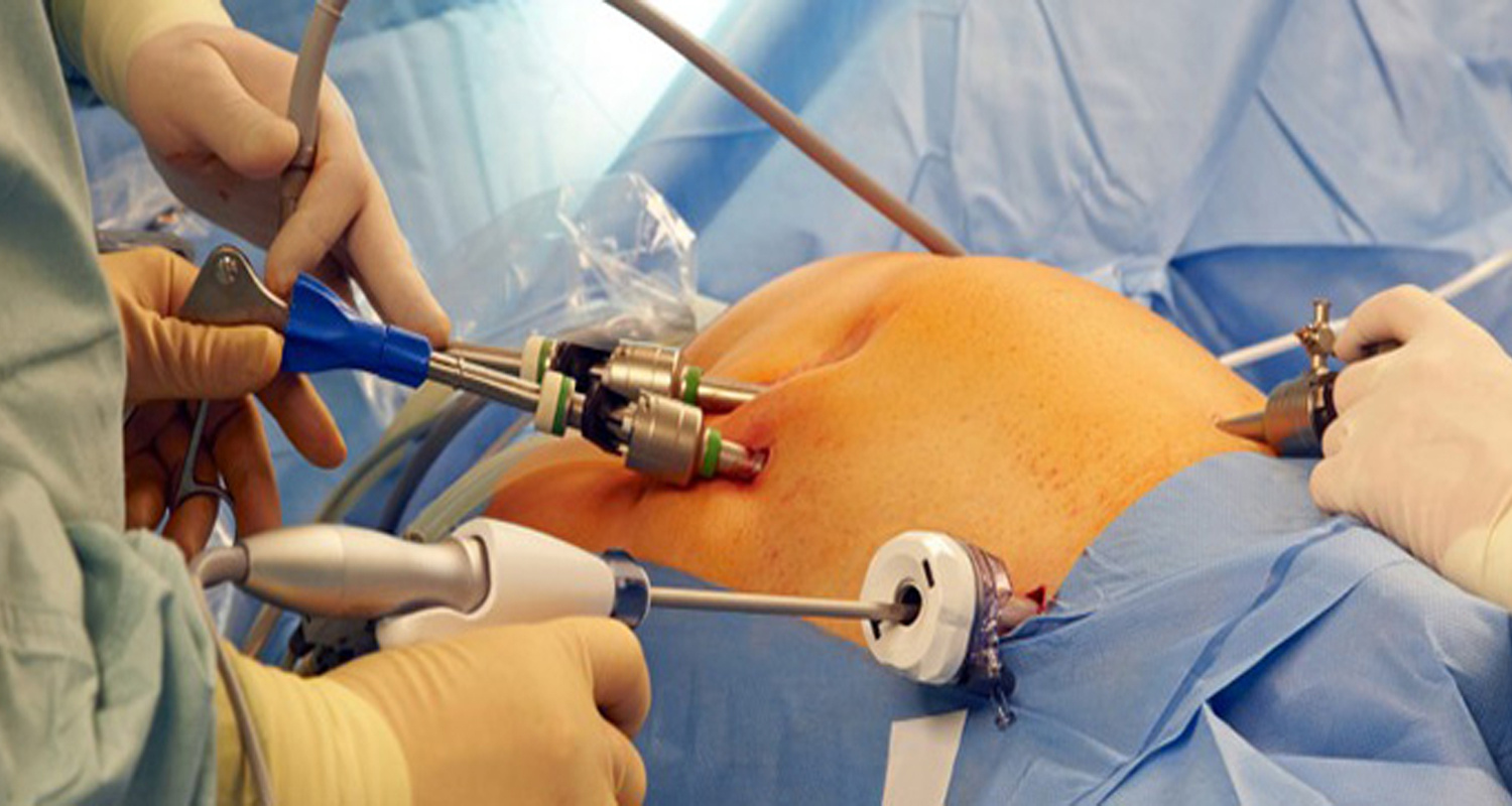 When is Laparoscopic Myomectomy Recommended by Dr. Sandip Sonara on ...